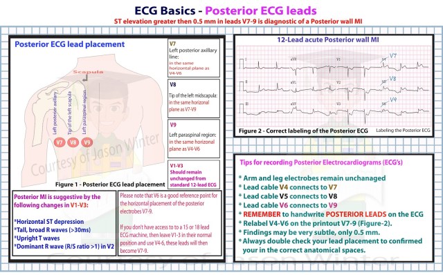 EKG Case of the Month – March – AOMC FOAMed