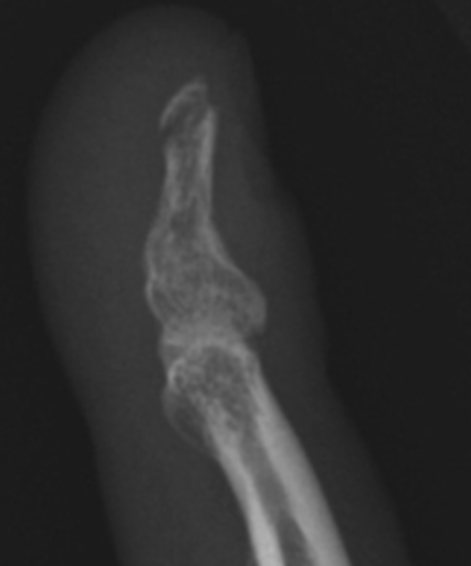 Approach to Nail Trauma – AOMC FOAMed