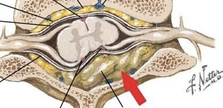 Spinal Epidural Abscess Ppt