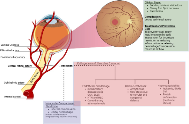 CRAO – AOMC FOAMed